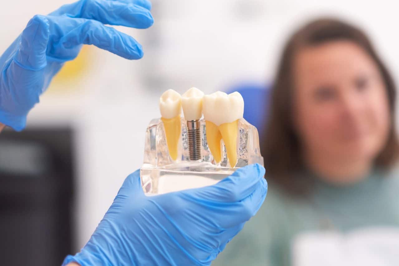Best Options to Replace Missing Teeth - Bexley Dental